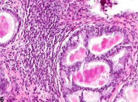 Seminal vesicle - Inflammation - Nonneoplastic Lesion Atlas