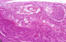 Testis - Rete Hyperplasia - Nonneoplastic Lesion Atlas