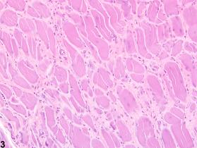 Skeletal muscle - Fibrosis - Nonneoplastic Lesion Atlas