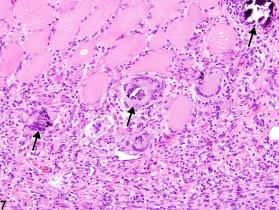 Skeletal muscle - Inflammation - Nonneoplastic Lesion Atlas