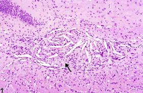 Brain - Cholesterol Clefts - Nonneoplastic Lesion Atlas