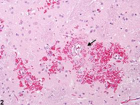 Brain - Hemorrhage - Nonneoplastic Lesion Atlas