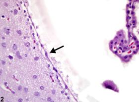 Brain - Hydrocephalus - Nonneoplastic Lesion Atlas