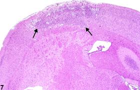 Brain - Necrosis - Nonneoplastic Lesion Atlas