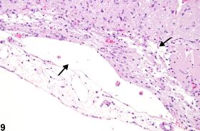 Brain - Necrosis - Nonneoplastic Lesion Atlas