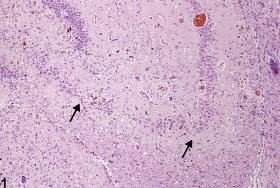 Brain, Neuron - Cell Loss - Nonneoplastic Lesion Atlas