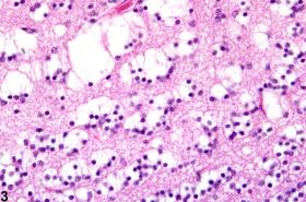 Brain, Neuron - Degeneration - Nonneoplastic Lesion Atlas