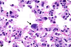 Lung - Atypia, Cellular - Nonneoplastic Lesion Atlas