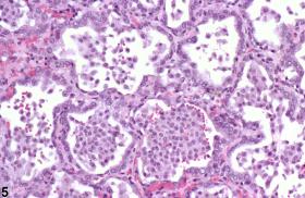 Lung, Epithelium, Alveolus - Hyperplasia - Nonneoplastic Lesion Atlas