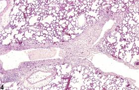 Lung - Fibrosis - Nonneoplastic Lesion Atlas