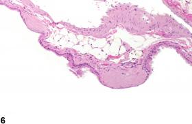 Lung - Fibrosis - Nonneoplastic Lesion Atlas