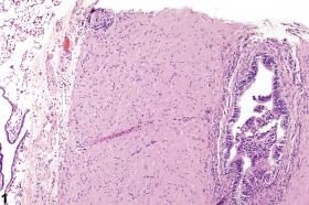 Lung - Hypertrophy, Smooth Muscle - Nonneoplastic Lesion Atlas