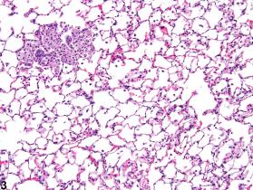 Lung - Infiltration Cellular, Histiocyte - Nonneoplastic Lesion Atlas