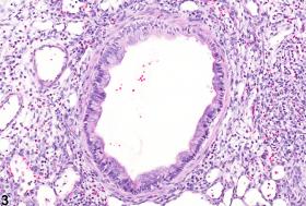 lung - Metaplasia, Goblet Cell - Nonneoplastic Lesion Atlas