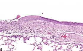 Lung - Metaplasia, Squamous - Nonneoplastic Lesion Atlas