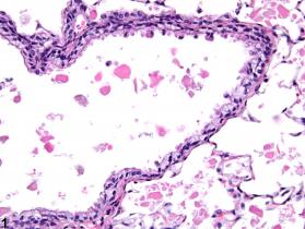 Lung - Vacuolization, Cytoplasmic - Nonneoplastic Lesion Atlas