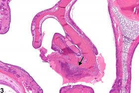 Nose - Inflammation - Nonneoplastic Lesion Atlas