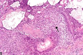 Ear - Inflammation - Nonneoplastic Lesion Atlas