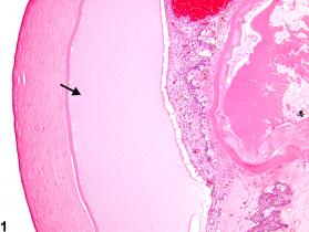 Eye, Anterior chamber - Proteinaceous fluid - Nonneoplastic Lesion Atlas