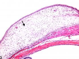 Eye, Conjunctiva - Edema - Nonneoplastic Lesion Atlas