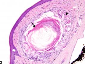 Eye, Cornea - Cyst - Nonneoplastic Lesion Atlas