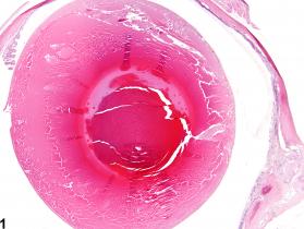 Eye, Lens - Cataract - Nonneoplastic Lesion Atlas