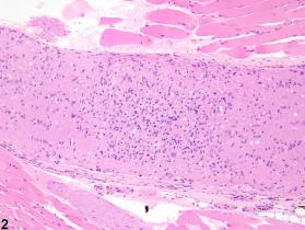 Eye, Optic Nerve - Gliosis - Nonneoplastic Lesion Atlas