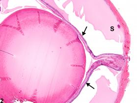 Eye, Retina - Detachment - Nonneoplastic Lesion Atlas
