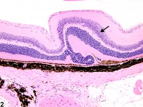 Eye, Retina - Dysplasia - Nonneoplastic Lesion Atlas