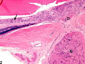 Eye, Retina - Gliosis - Nonneoplastic Lesion Atlas