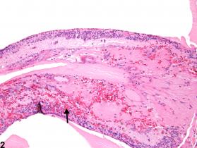 Eye, Retina - Hemorrhage - Nonneoplastic Lesion Atlas