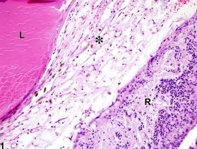 Eye, Vitreous - Fibrosis - Nonneoplastic Lesion Atlas