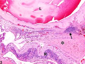 Eye, Vitreous - Fibrosis - Nonneoplastic Lesion Atlas