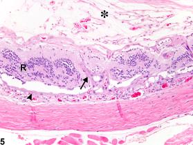 Eye, Vitreous - Fibrosis - Nonneoplastic Lesion Atlas