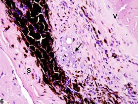Eye, Vitreous - Fibrosis - Nonneoplastic Lesion Atlas