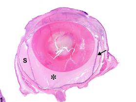 Eye, Vitreous - Proteinaceous Fluid - Nonneoplastic Lesion Atlas