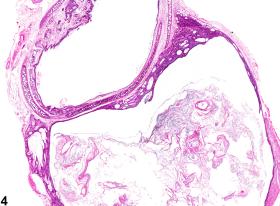 zymbal's gland - Duct - Cyst - Nonneoplastic Lesion Atlas