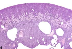 Kidney - Cyst - Nonneoplastic Lesion Atlas
