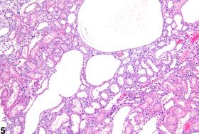 Kidney - Cyst - Nonneoplastic Lesion Atlas