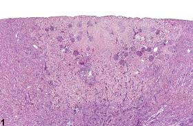 Kidney - Infarct - Nonneoplastic Lesion Atlas