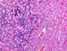 Kidney - Nephroblastematosis - Nonneoplastic Lesion Atlas