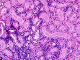 Kidney - Nephroblastematosis - Nonneoplastic Lesion Atlas