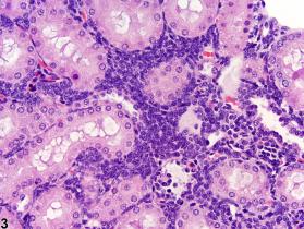 Kidney - Nephroblastematosis - Nonneoplastic Lesion Atlas