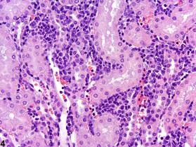Kidney - Nephroblastematosis - Nonneoplastic Lesion Atlas